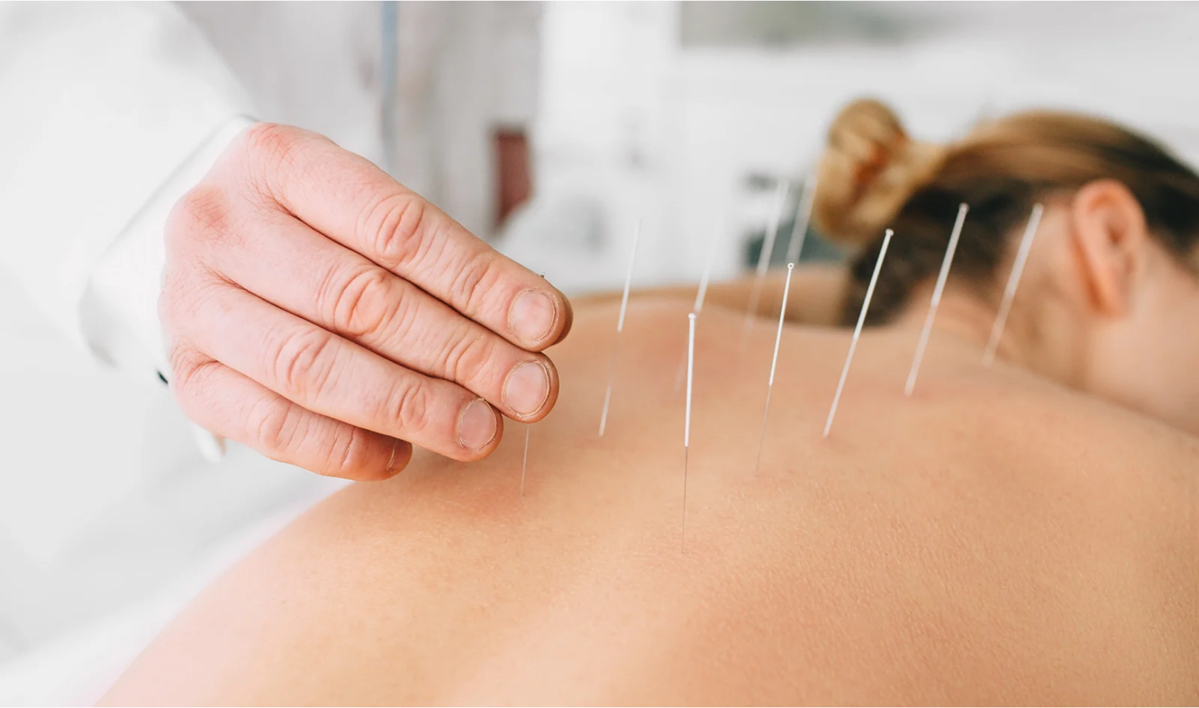 Experience the Benefits of Acupuncture for Seasonal Allergies ...